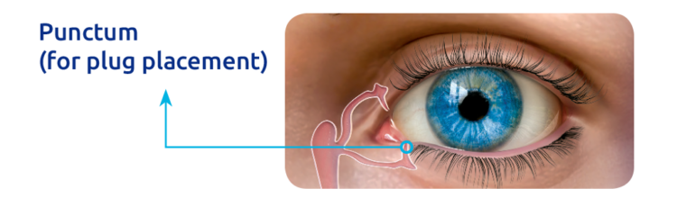 Dry Eye Relief Athens | Dry Eye Syndrome Greensboro, GA